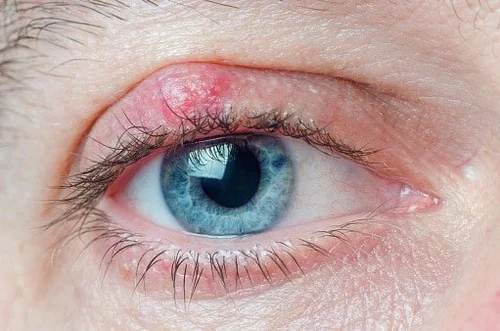 Swollen Eyelid: Causes, Symptoms, and Treatment | Eye Concepts