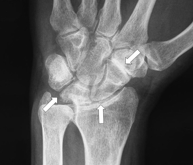 Artrosi radiocarpica