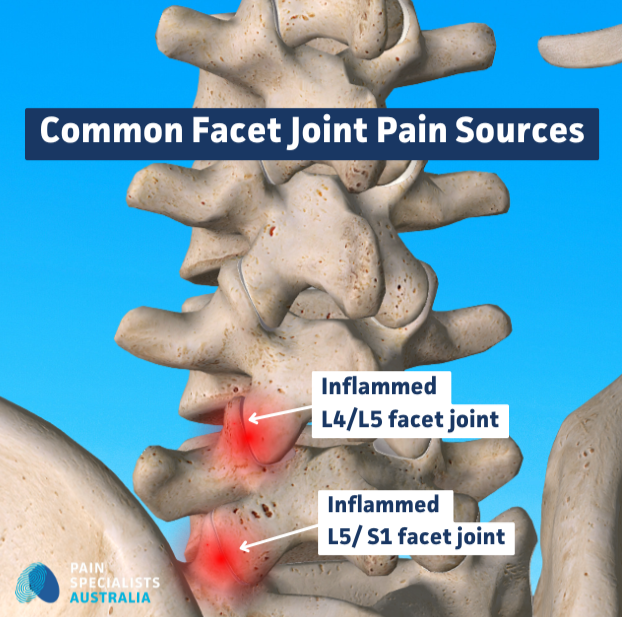 Facet Joint Injections and Radiofrequency Melbourne | Back Pain Experts ...