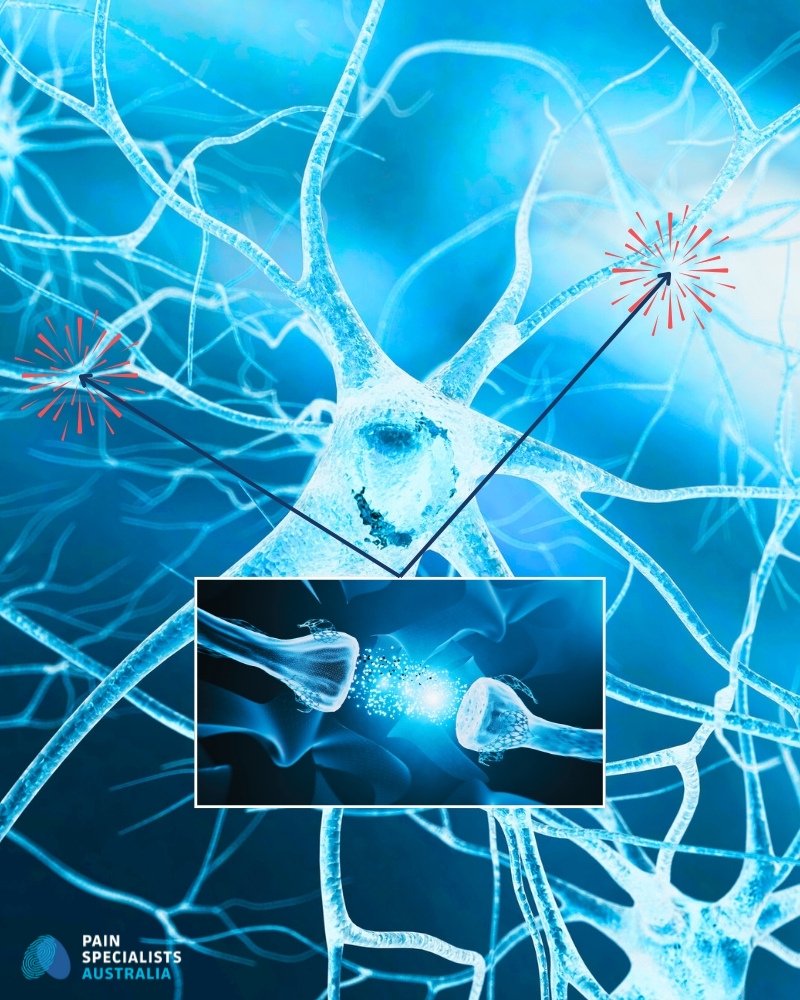 Nerve Pain Treatment | Pain Specialists Australia — Pain Specialists ...