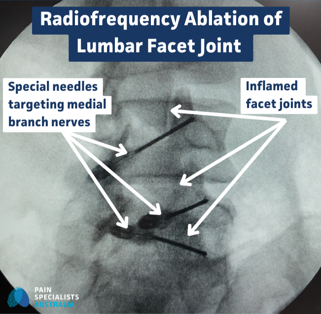 Facet Joint Injections and Radiofrequency Melbourne | Back Pain Experts ...