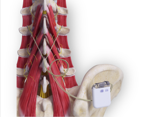 Multifidus Muscle Stimulation — Pain Specialists Australia