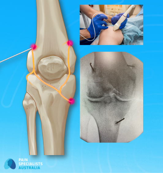 Knee Injections Melbourne | What Works When Pain Persists — Pain ...