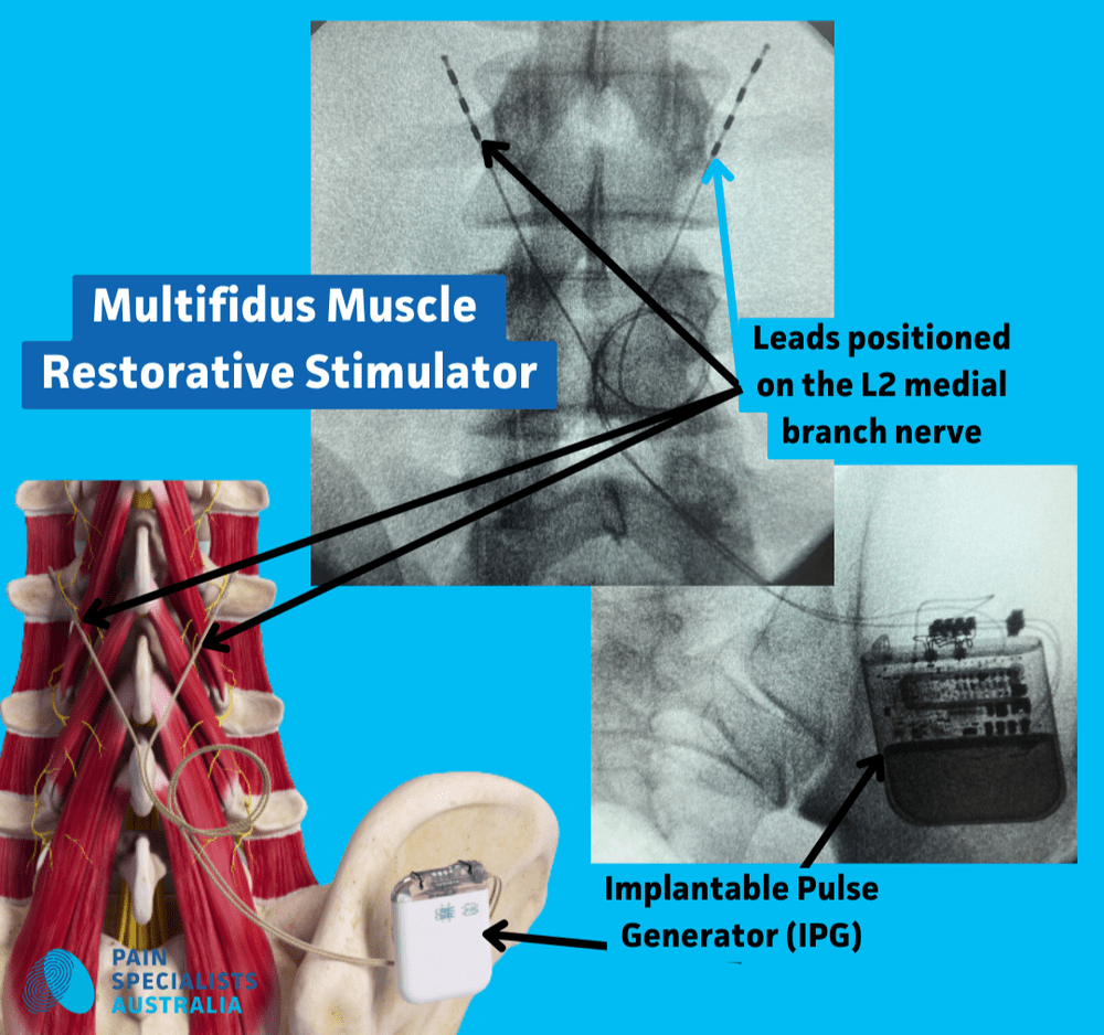Multifidus Muscle Stimulation for Chronic Back Pain | Melbourne — Pain ...