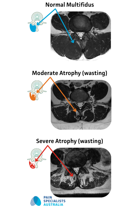 Multifidus Muscle Stimulation for Chronic Back Pain | Melbourne — Pain ...
