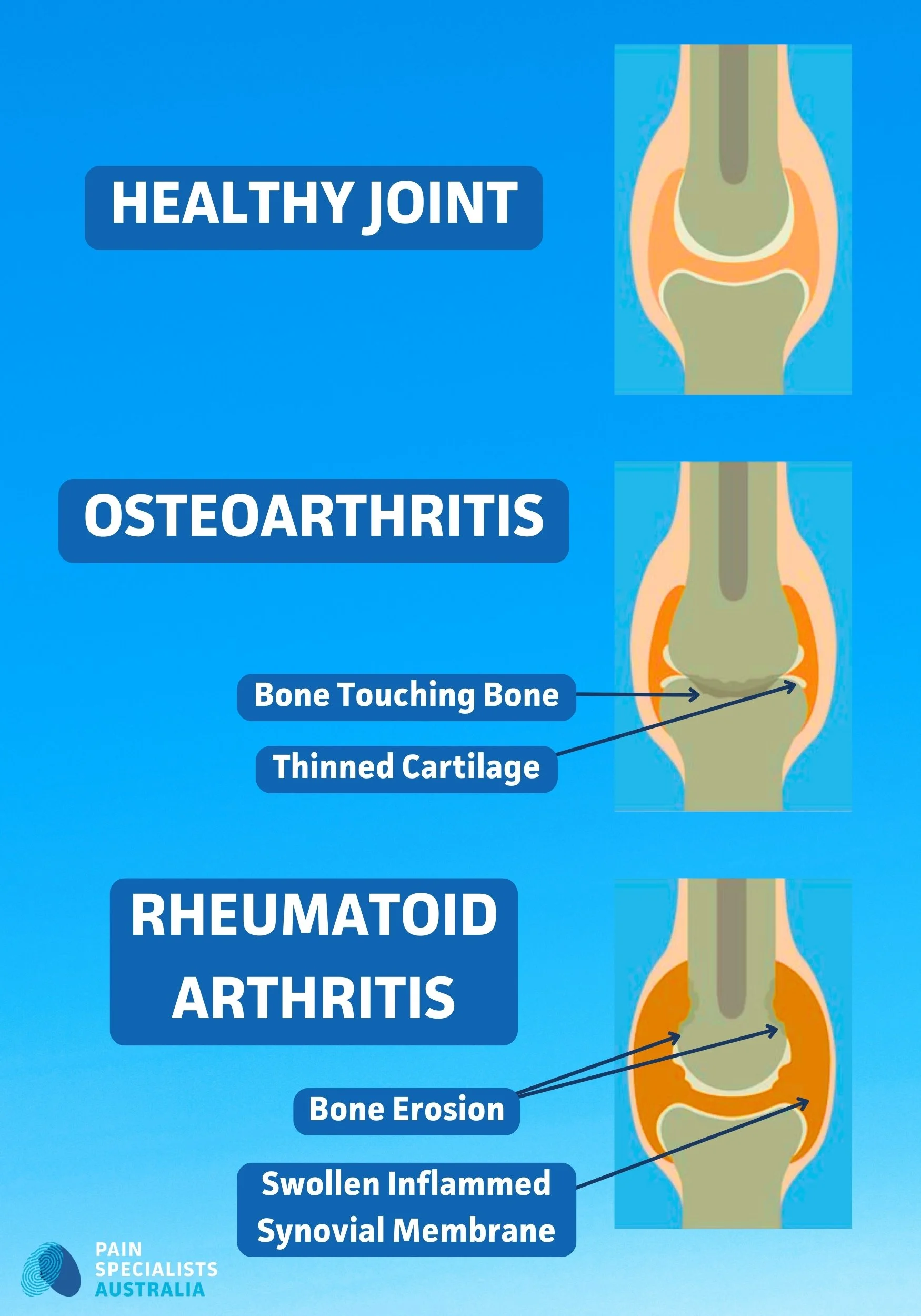 Arthritis Pain Relief and Management in Melbourne | Causes, Symptoms ...