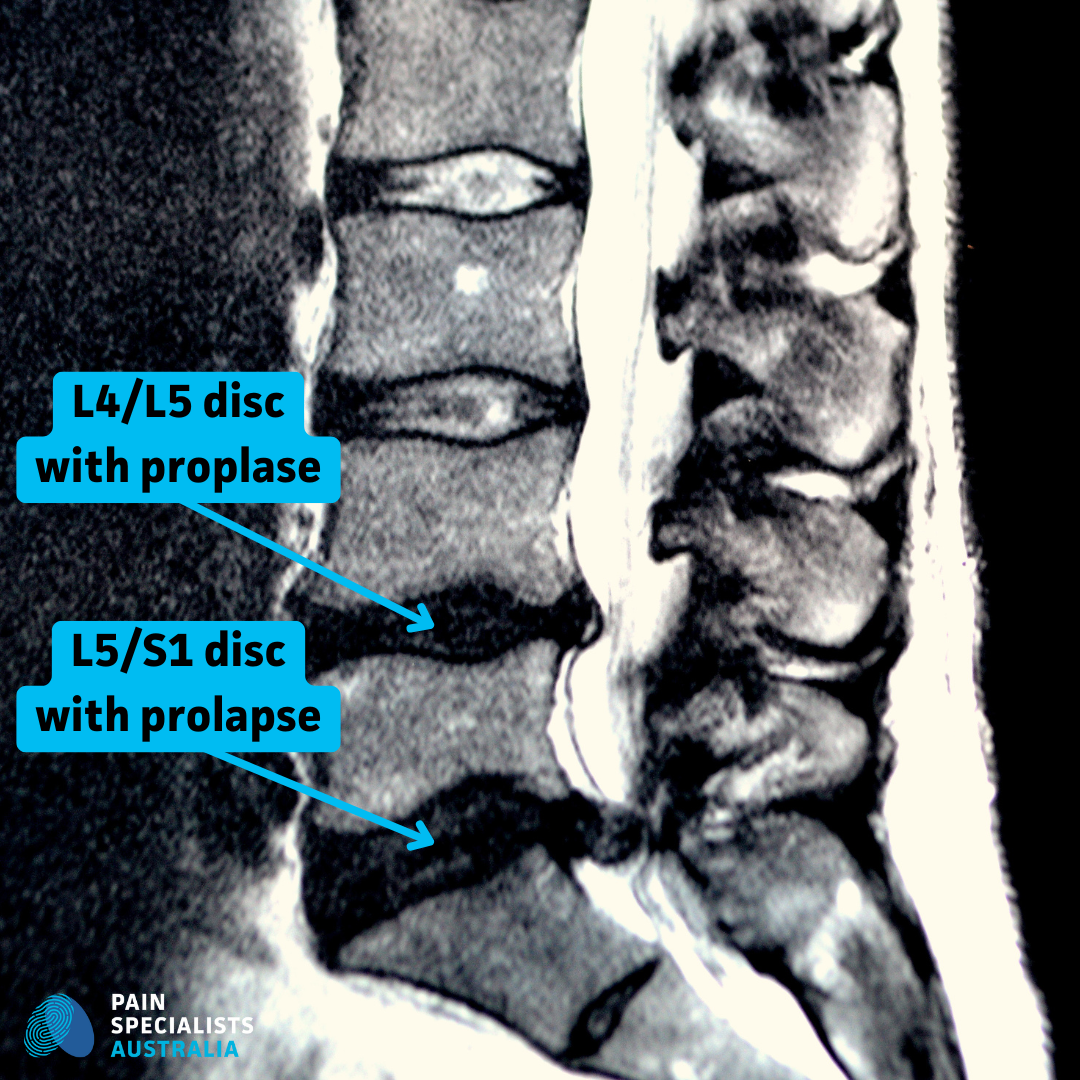 Non-Surgical Treatments for Degenerative Disc Disease — Pain ...