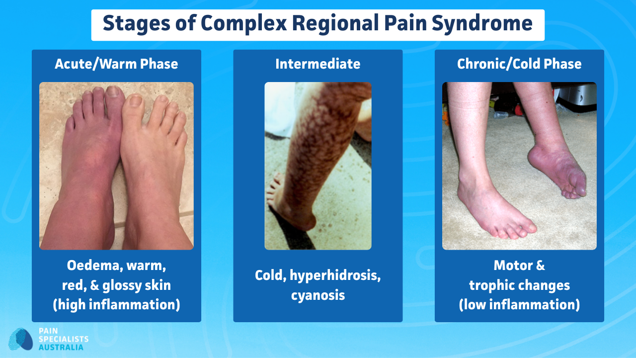 CRPS Expert Diagnosis & Treatment Melbourne — Pain Specialists Australia