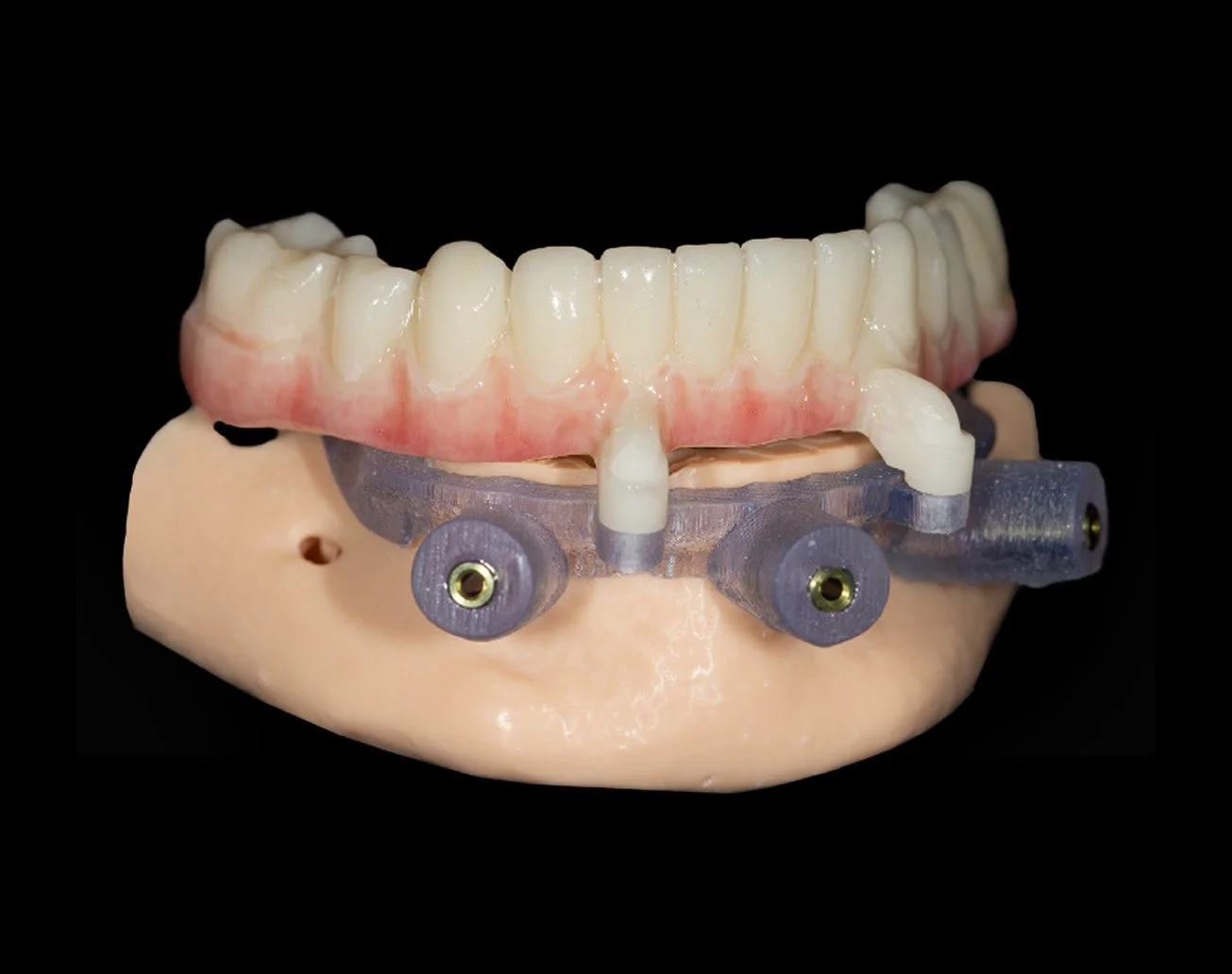 Styledent | Dental Lab | Feldspathic Veneers | Dental Implants | Full ...