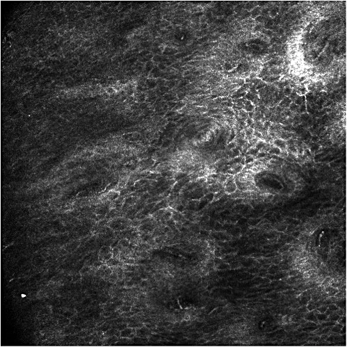 Handheld Reflectance Confocal Microscopy in EMPD Treatment — myEMPD.com