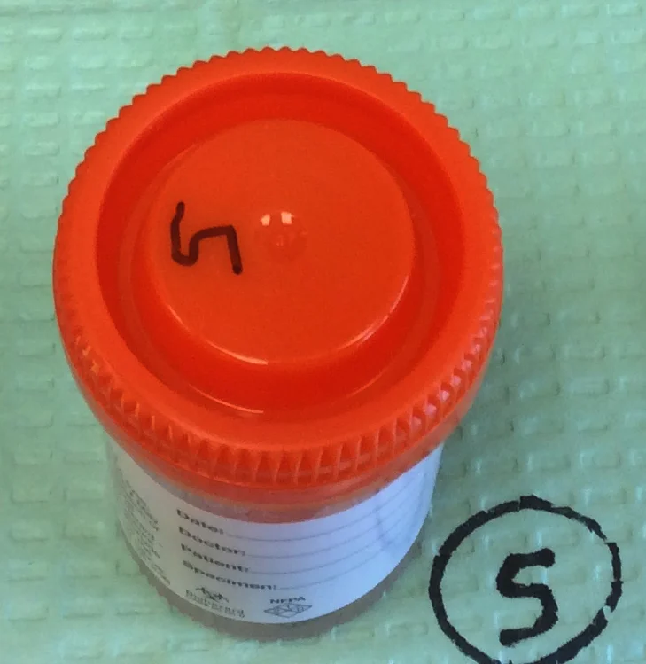 Mohs Micrographic Surgery for EMPD — myEMPD.com