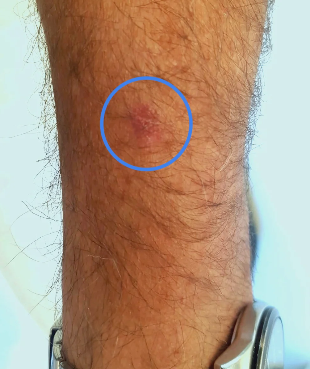 Learn about extramammary Paget’s disease (EMPD) — myEMPD.com