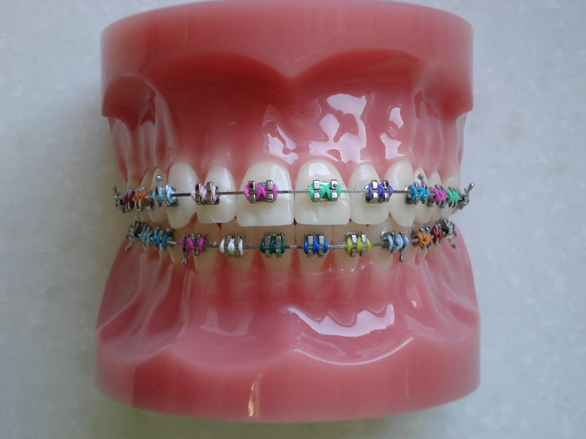 Before and Afters | Brace Club | Brace Club | Guildford, Surrey