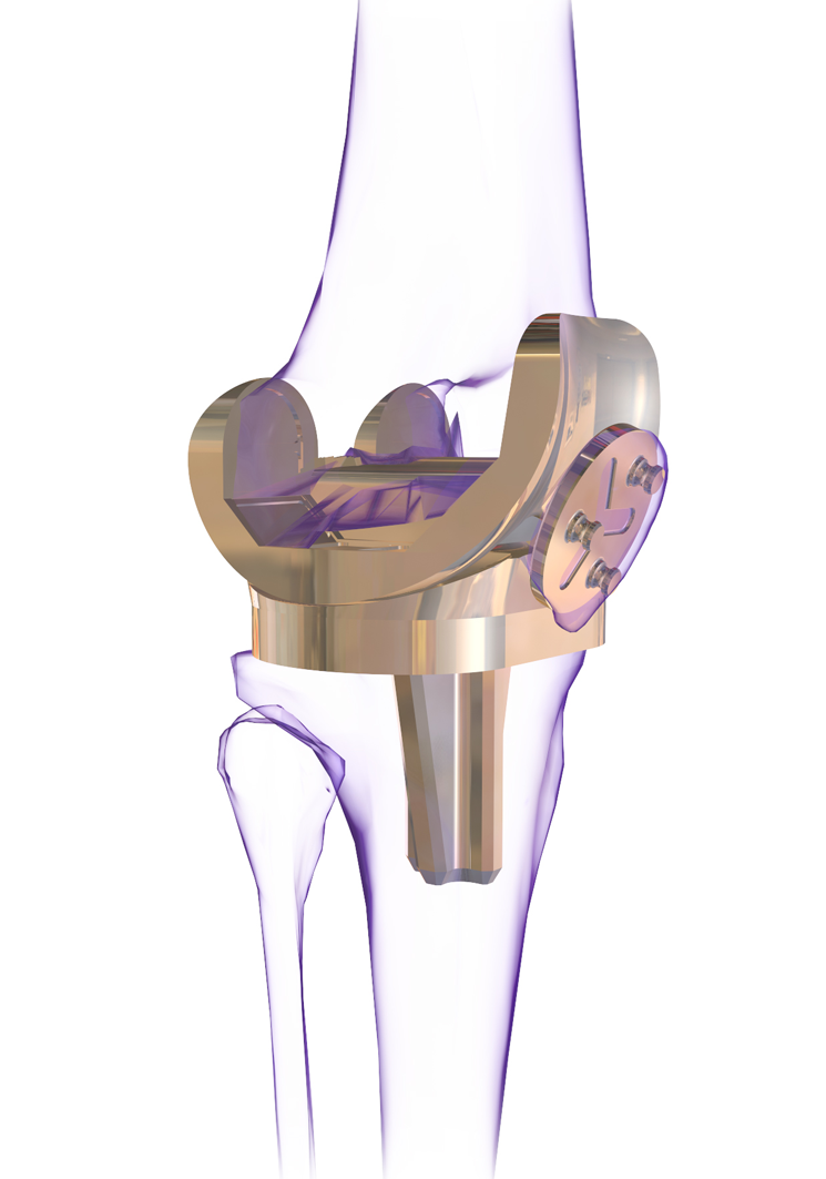 Patient Information Leaflets — Nigel Donnachie Hip & Knee Surgeon