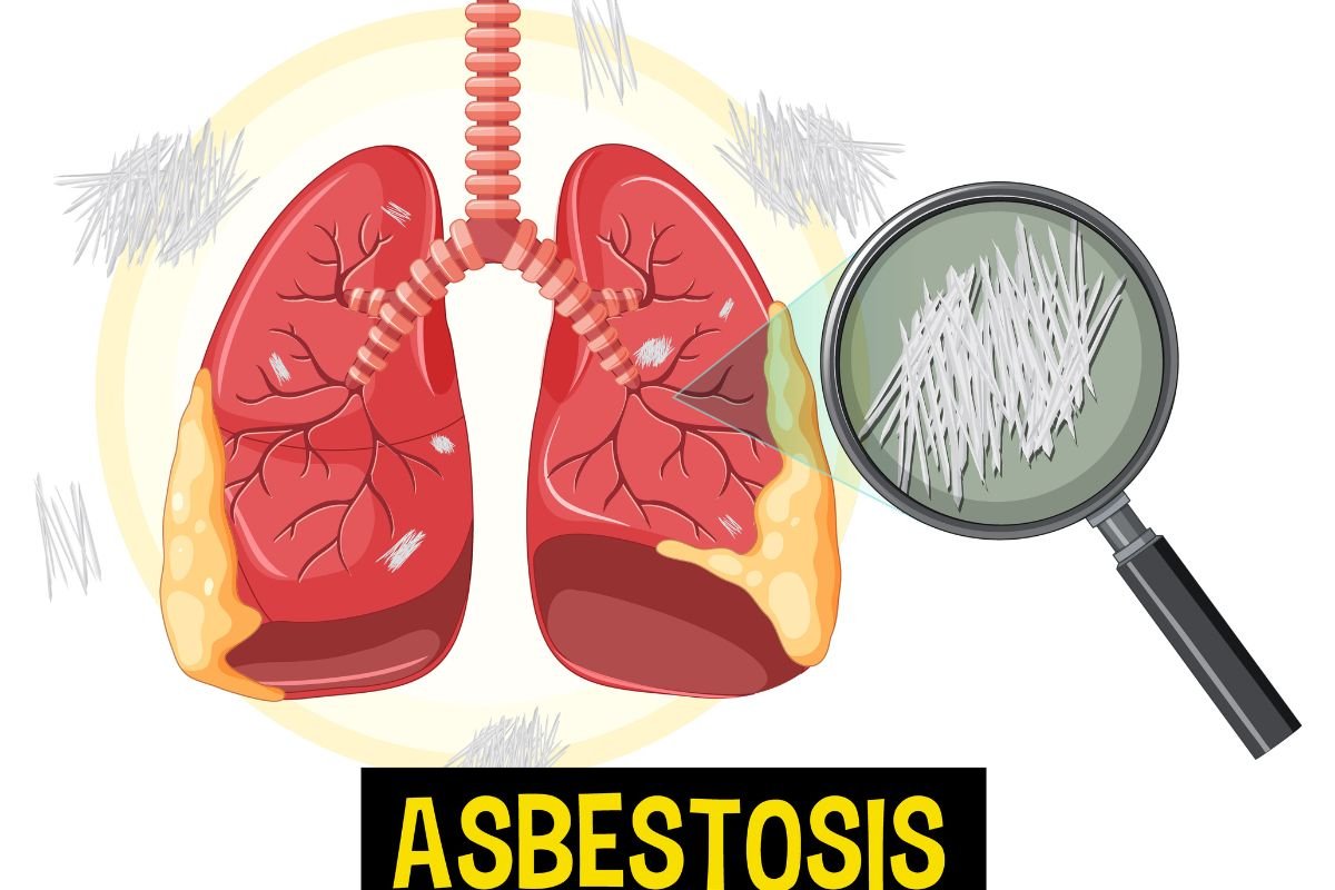 Seeking Compensation for Asbestos-Related Injuries? Here’s What You ...