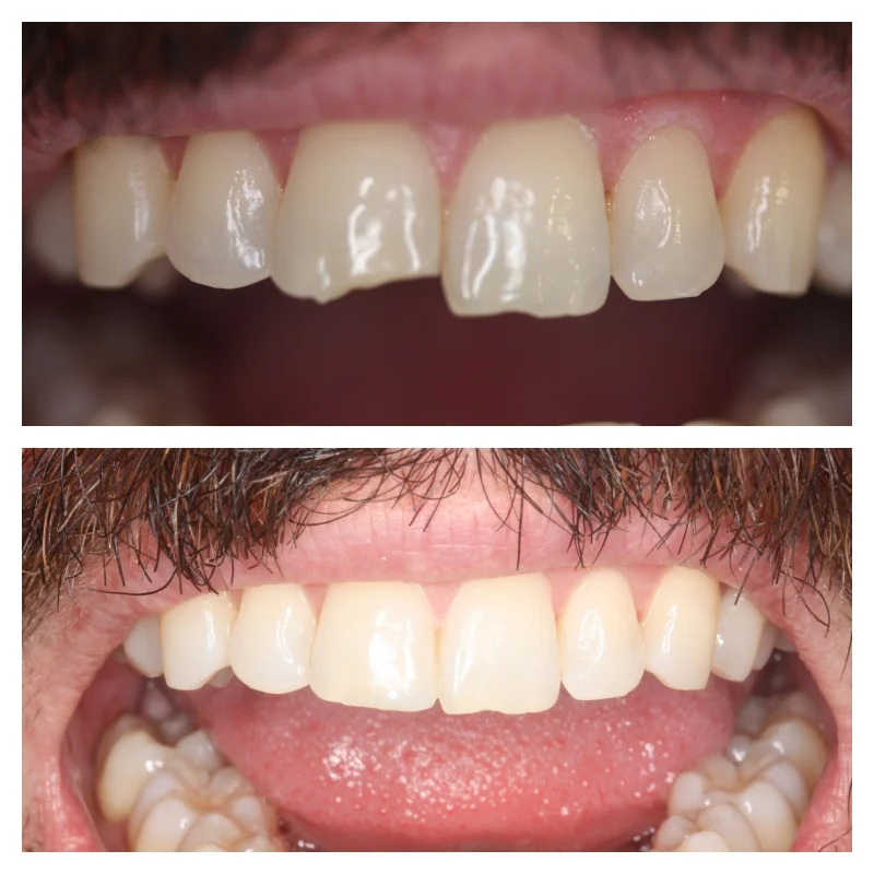 Tooth bonding at Brisbane Smile Boutique Dentists | Brisbane Smile ...