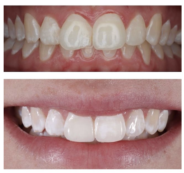 COMPOSITE RESIN RESTORATIONS | Brisbane Smile Boutique Dentists ...