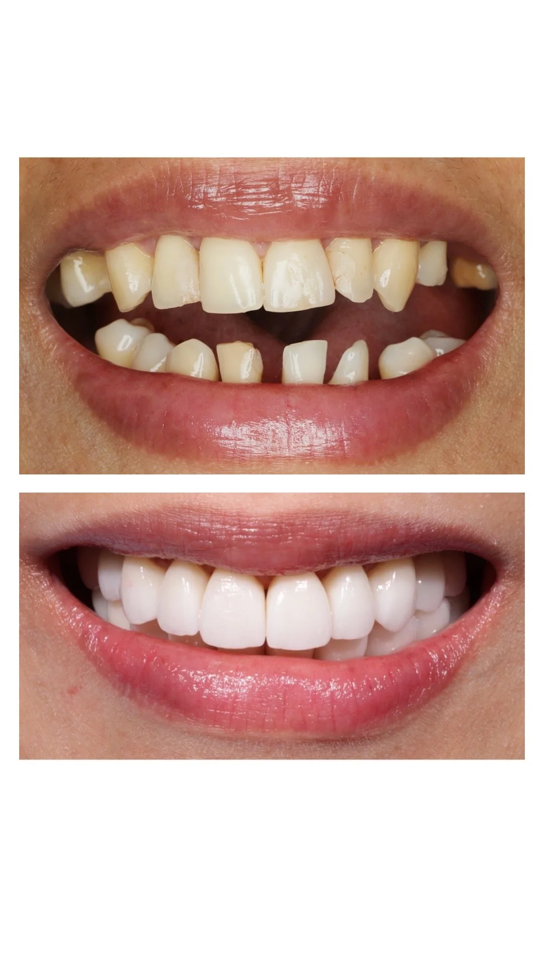 PORCELAIN RESTORATIONS At Brisbane Smile Boutique | Brisbane Smile ...