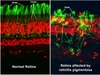 Usher Syndrome | Most Common Genetic Form of Deafblindness — Hearing ...