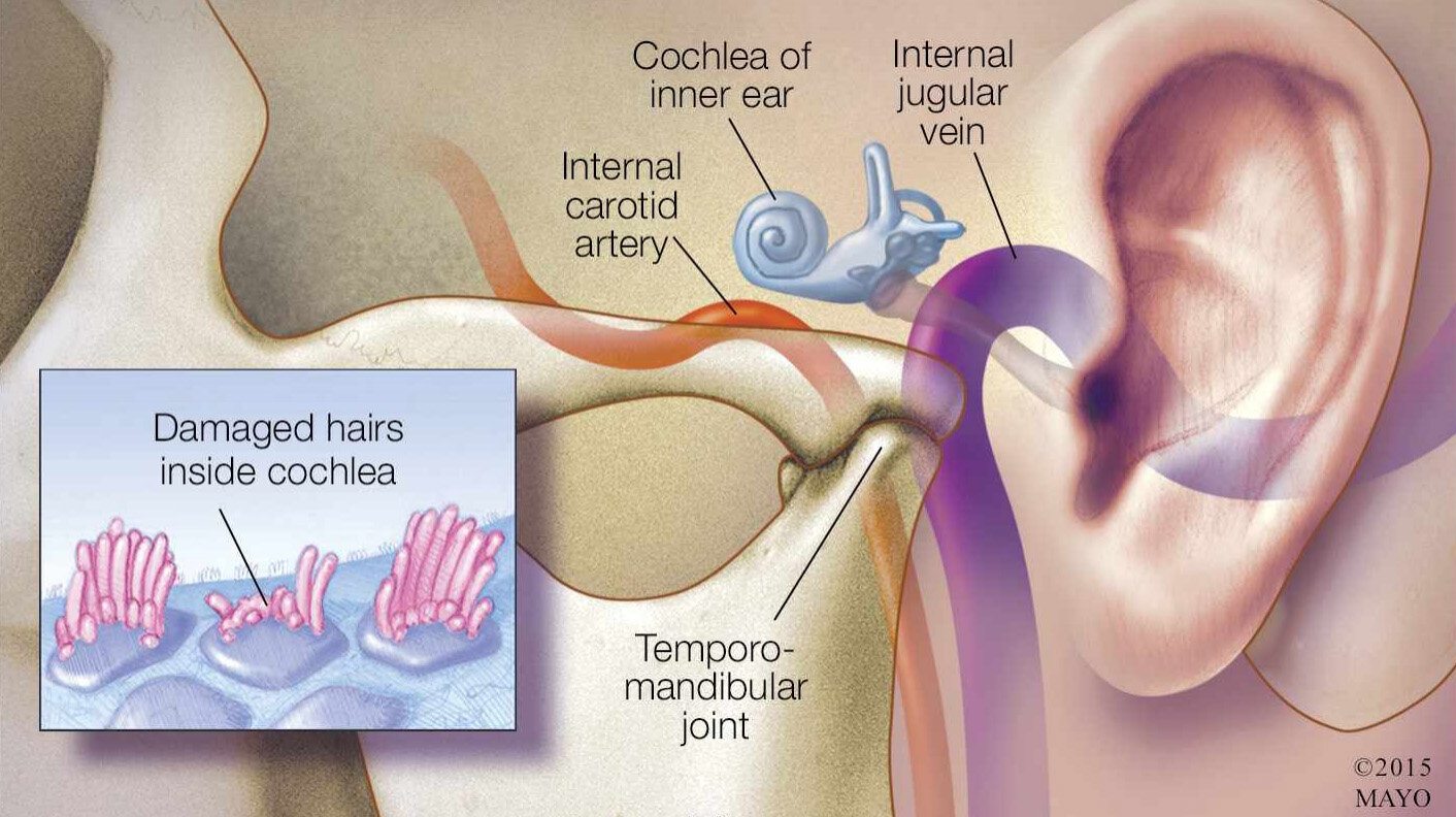 Tinnitus Ringing In The Ears Hearing Health Foundation