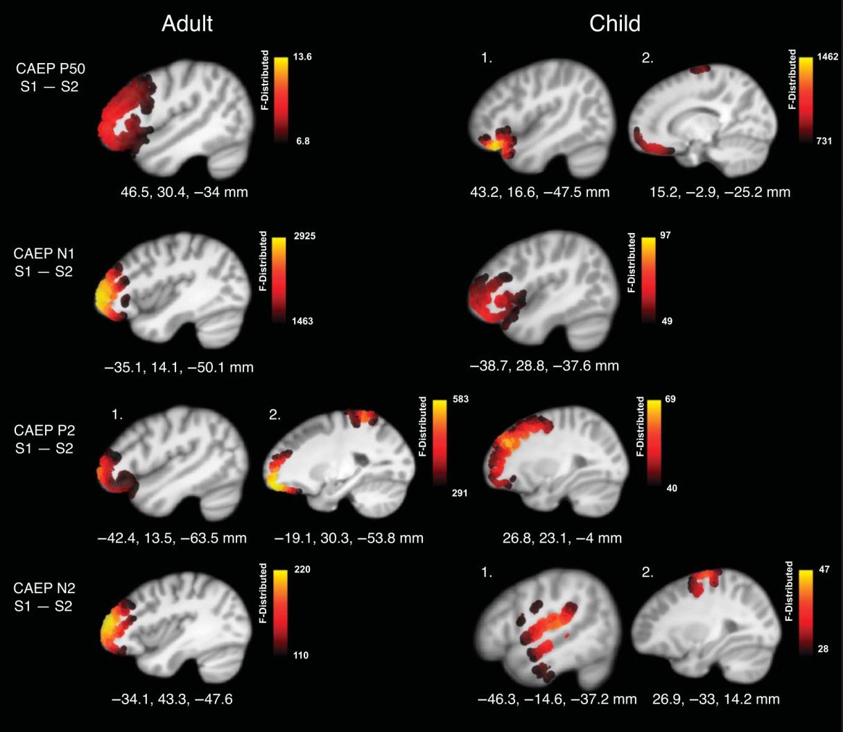 How Sensory Gating May Aid in Better Perception of Speech in Noise ...