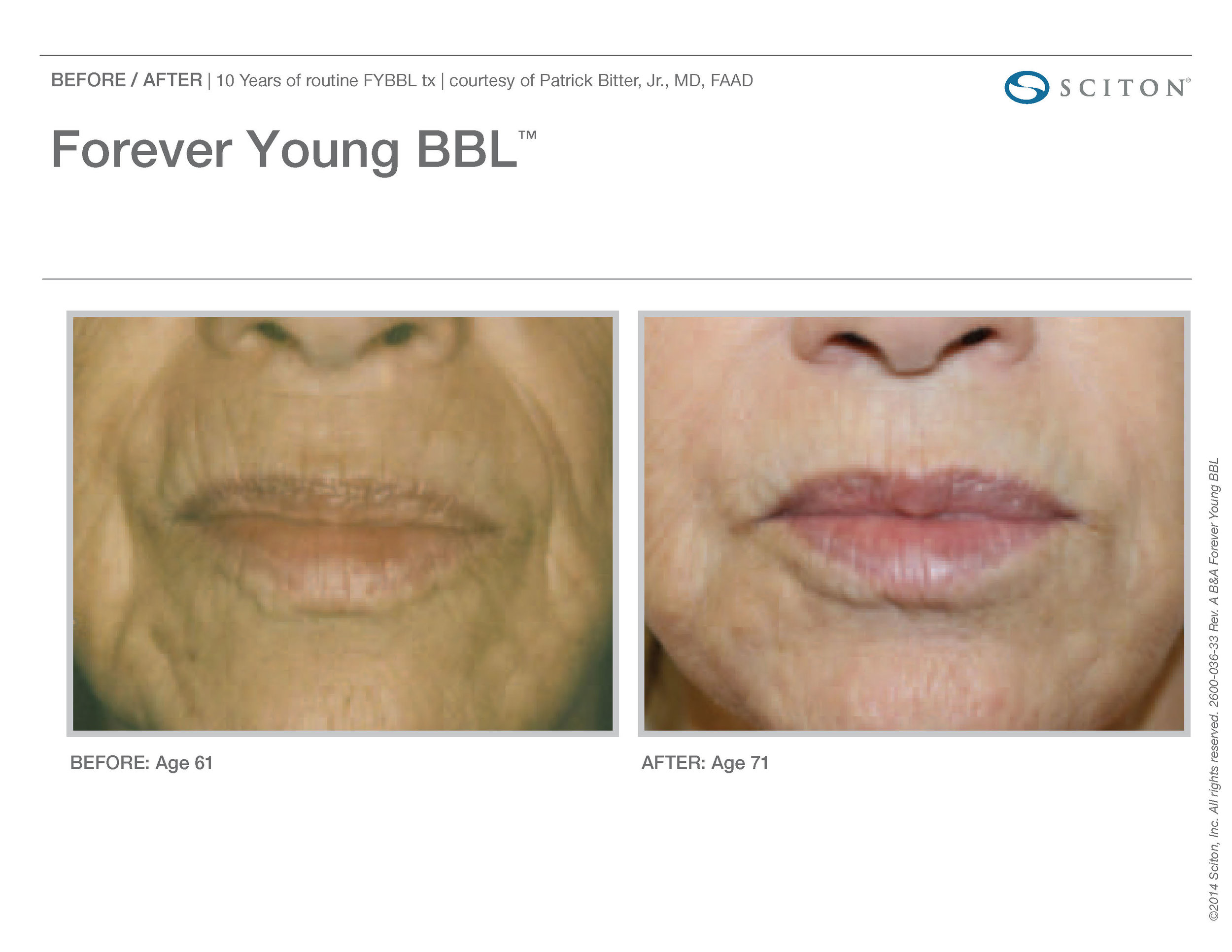 Forever Young Laser — skinRN aesthetics