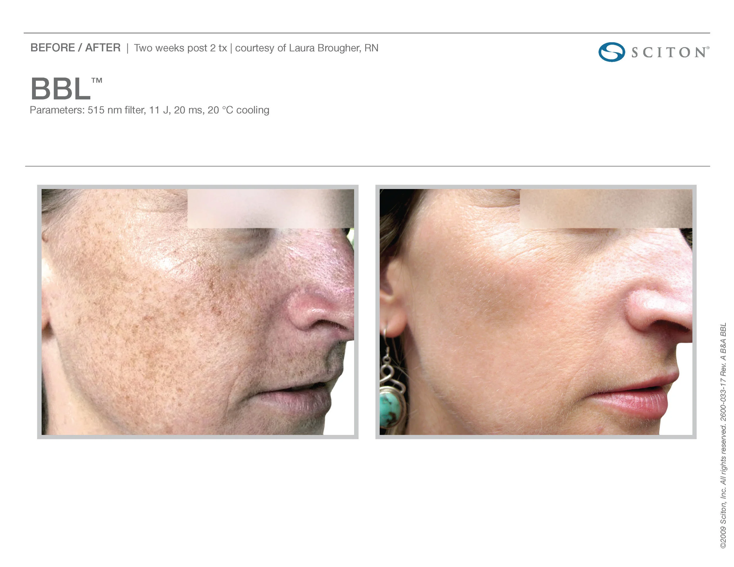 Forever Young Laser — skinRN aesthetics