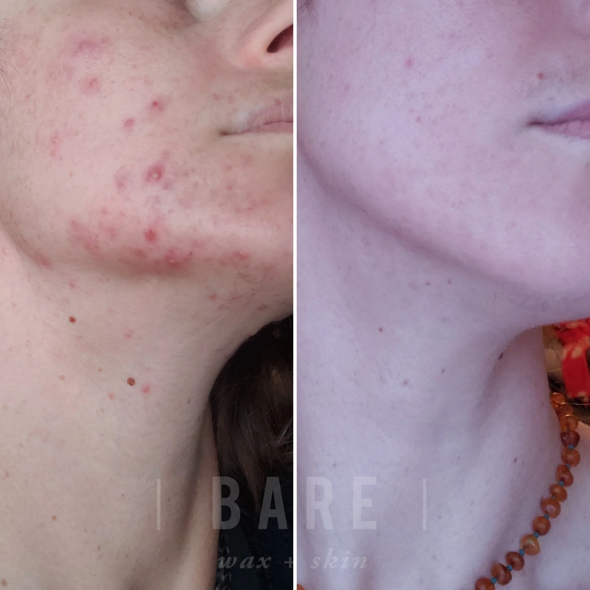 Clarisonic Before And After Acne Scars