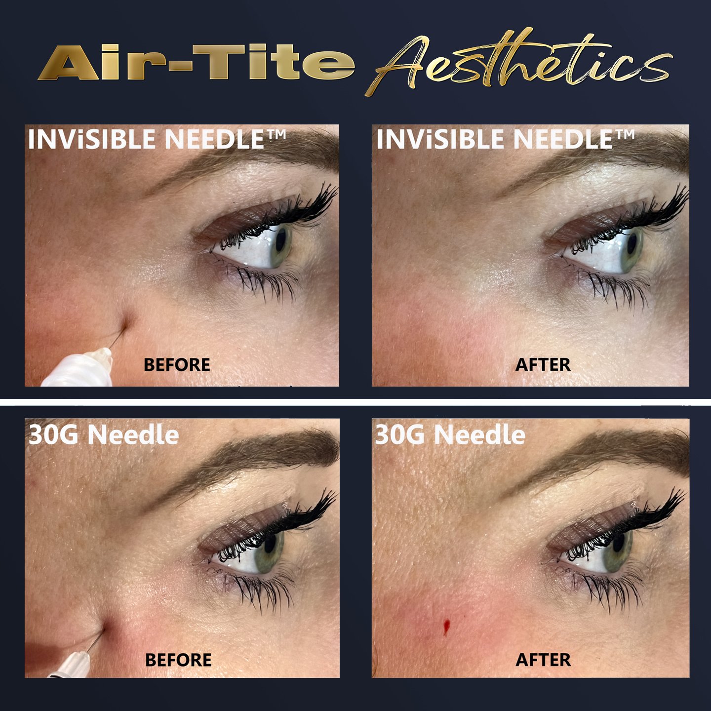 THE INViSIBLE NEEDLE™ — Air-Tite Aesthetics