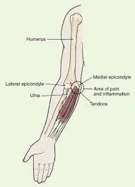 Causes Of Elbow Pain When Lifting Weights — EugeneTheFit.com