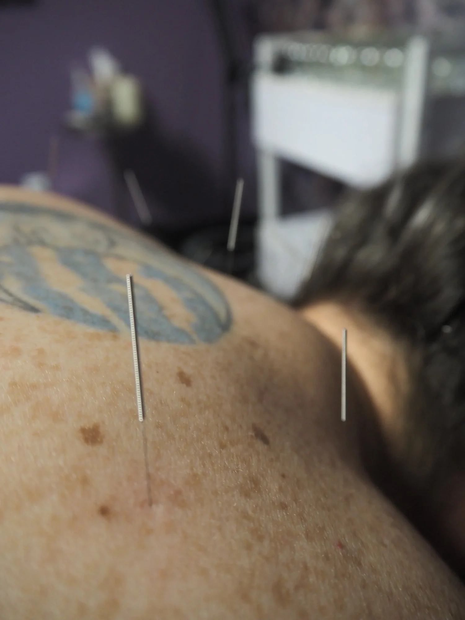 Acupuncture + Fire Cupping — OPEN SKY DAY SPA