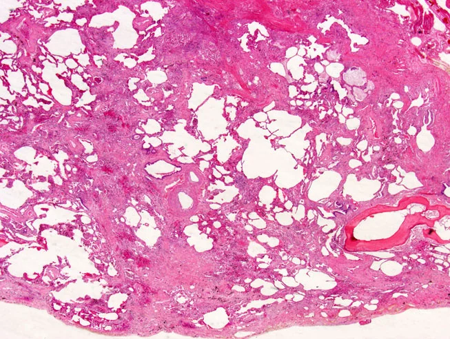 Pulmonary Fibrosis Histology