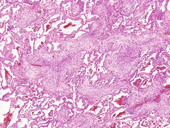 Pulmonary Edema Histology Macrophages