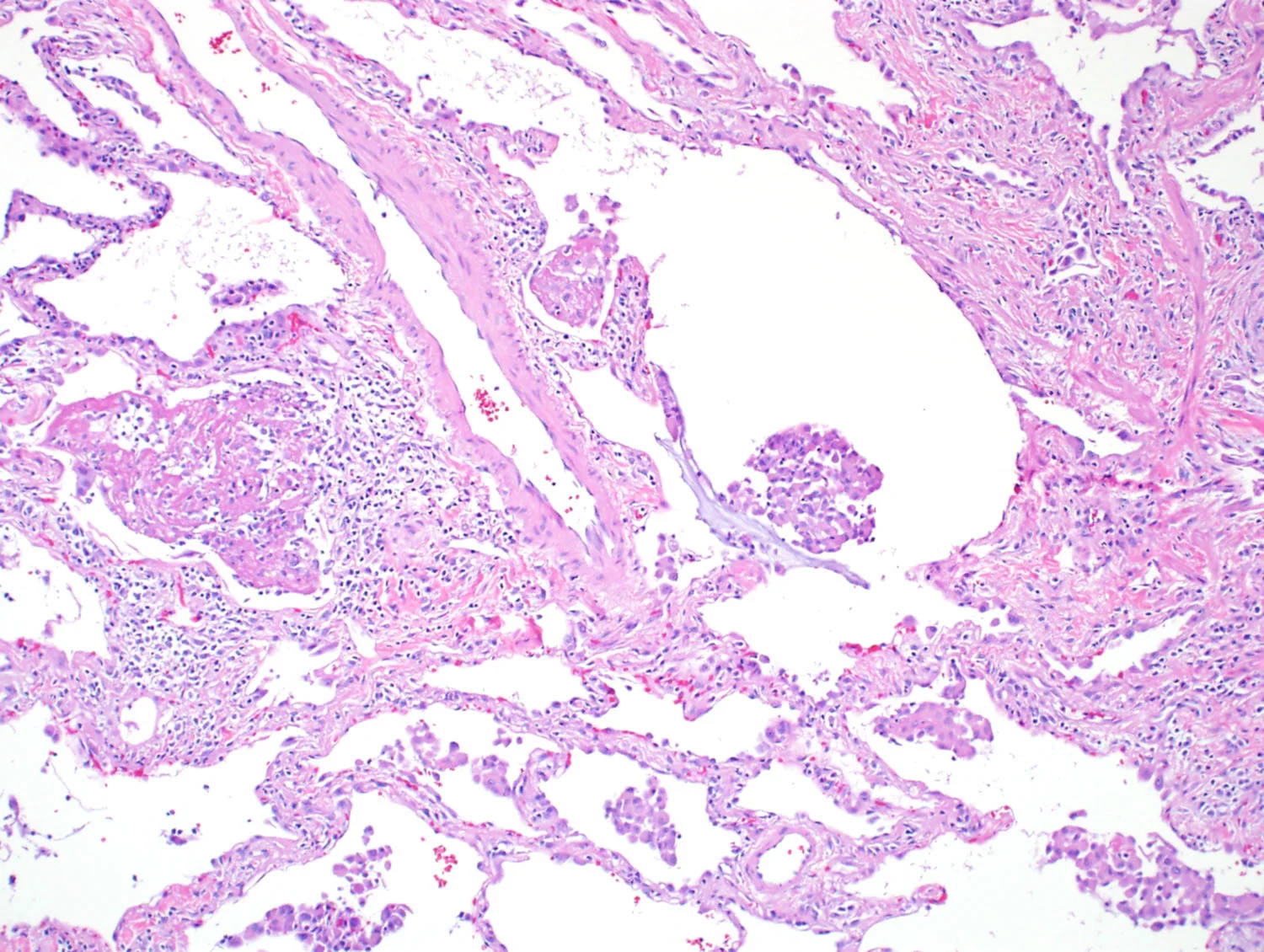 Fibrosis Subpatterns — 6 Patterns of Pulmonary Pathology
