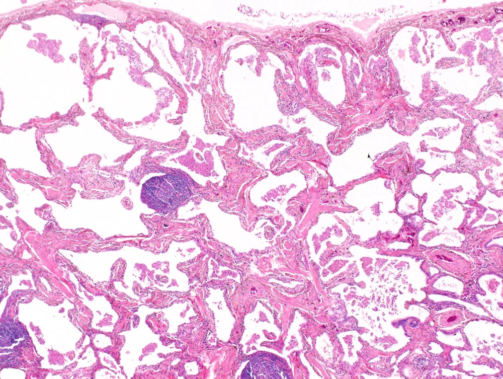 Fibrosis Subpatterns — 6 Patterns of Pulmonary Pathology