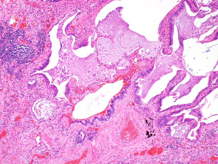 Fibrosis w/ Honeycombing Only — 6 Patterns of Pulmonary Pathology