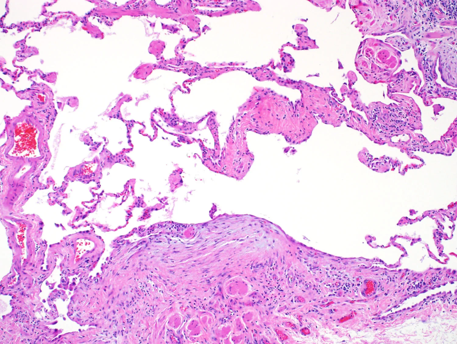 Usual Interstitial Pneumonia — 6 Patterns of Pulmonary Pathology