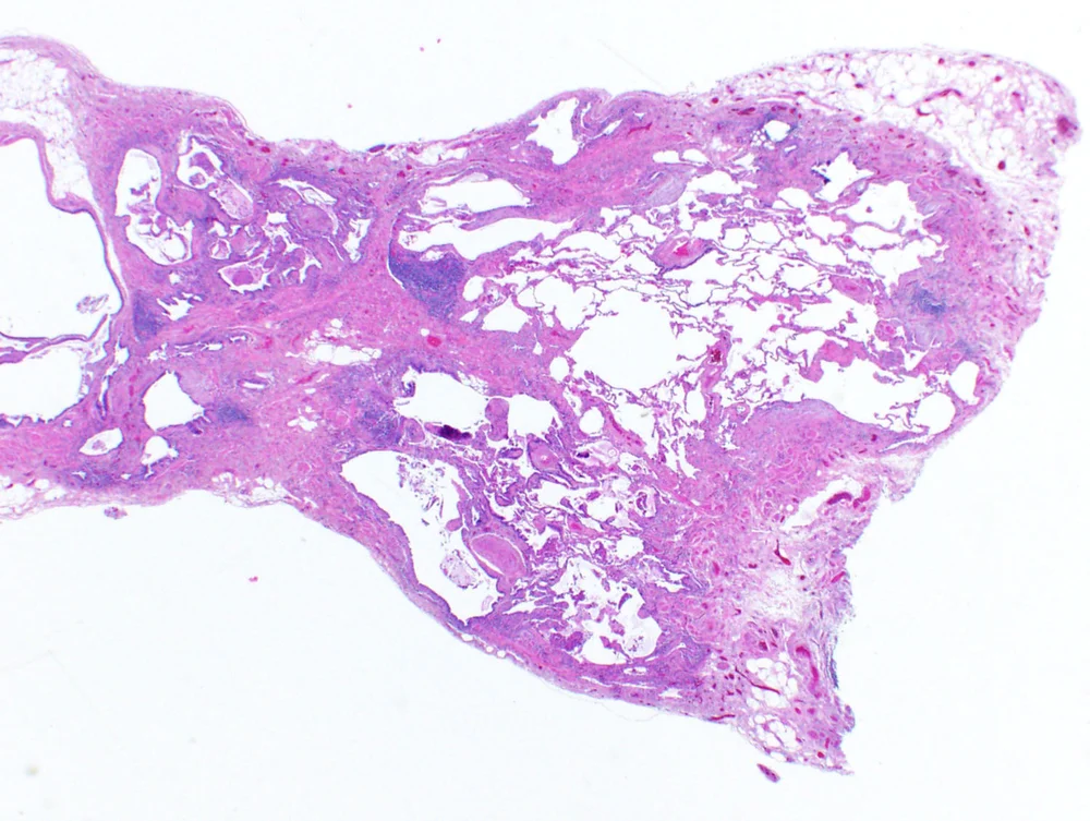 Usual Interstitial Pneumonia — 6 Patterns of Pulmonary Pathology