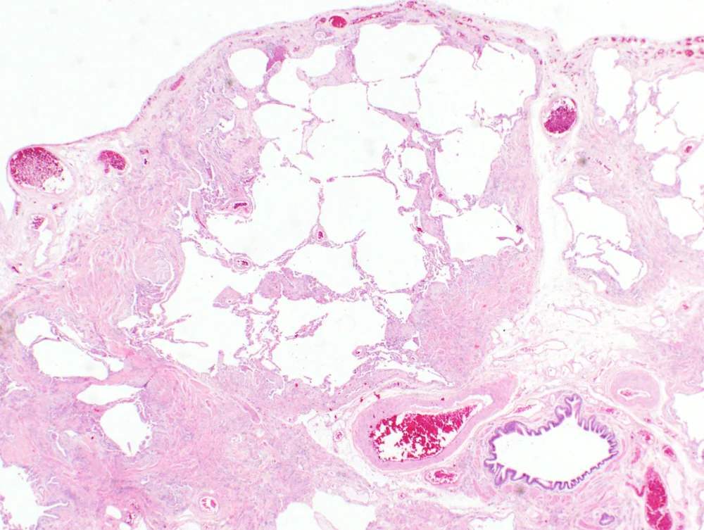 Usual Interstitial Pneumonia — 6 Patterns of Pulmonary Pathology