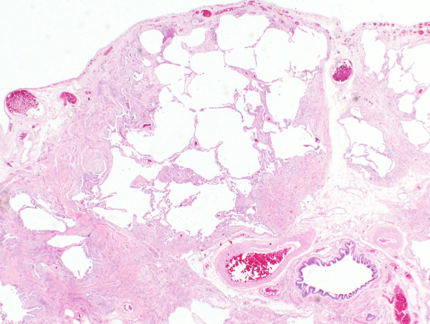 Usual Interstitial Pneumonia — 6 Patterns of Pulmonary Pathology