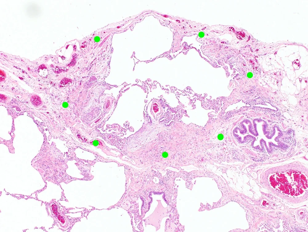 Usual Interstitial Pneumonia — 6 Patterns of Pulmonary Pathology