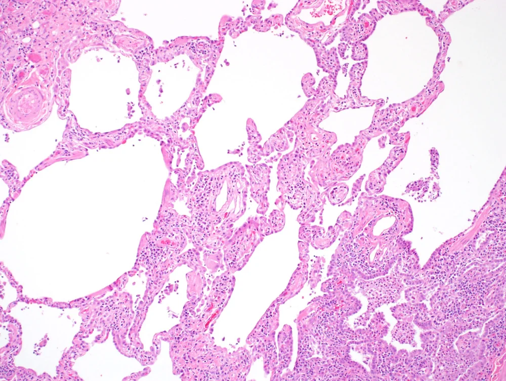 Usual Interstitial Pneumonia — 6 Patterns of Pulmonary Pathology