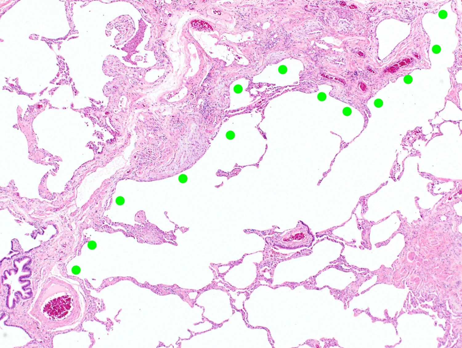 Usual Interstitial Pneumonia — 6 Patterns of Pulmonary Pathology