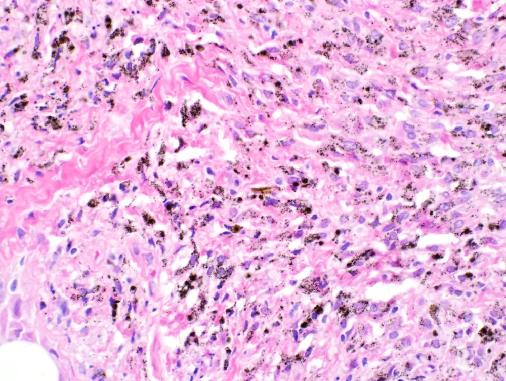 Usual Interstitial Pneumonia — 6 Patterns of Pulmonary Pathology