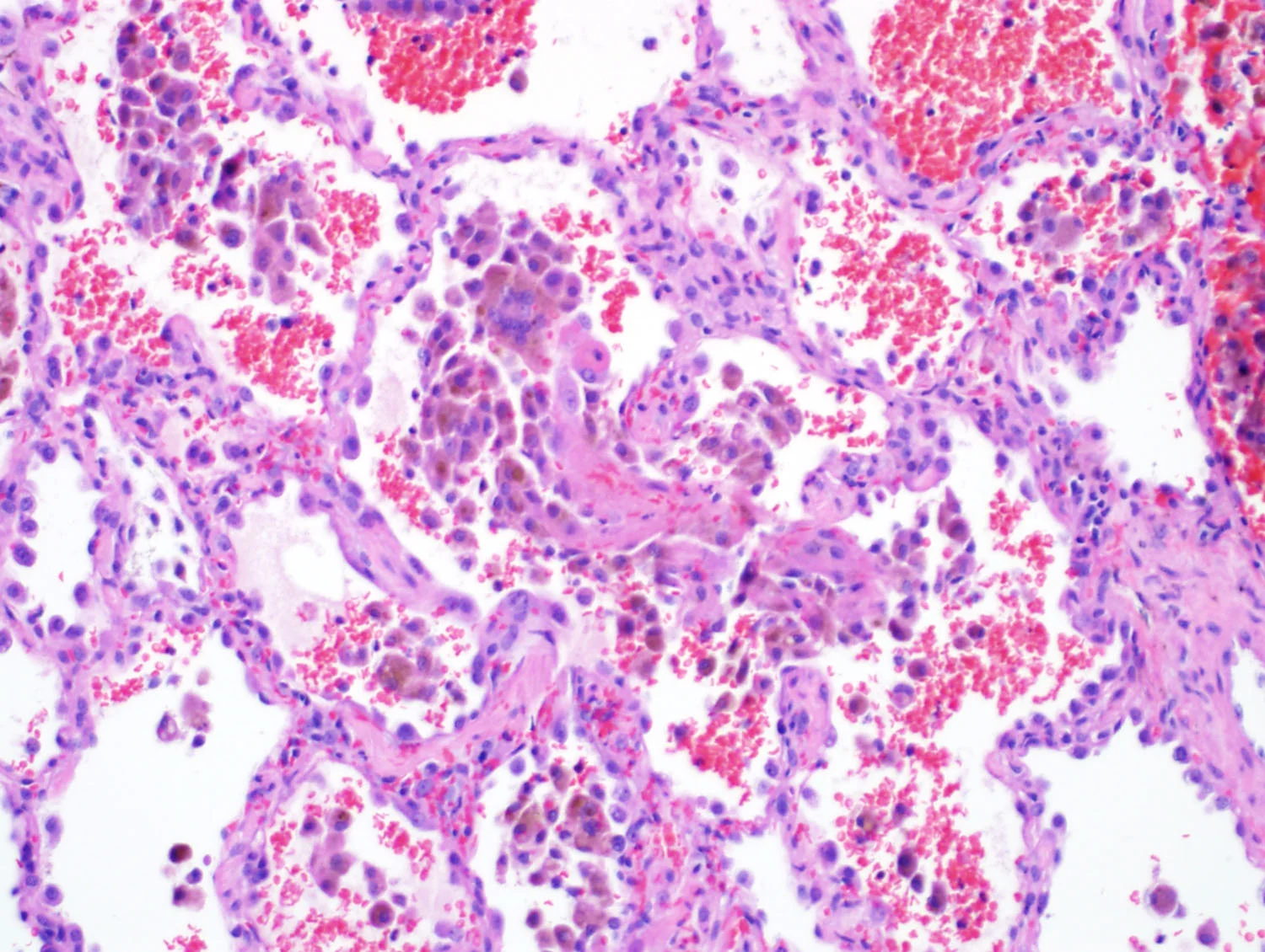 ALI w/ Hemosiderin Macrophages — 6 Patterns of Pulmonary Pathology