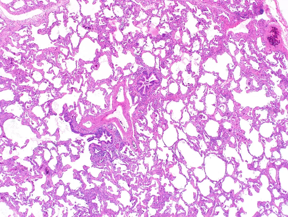 Pattern 3 - Cellular Infiltrates — 6 Patterns of Pulmonary Pathology
