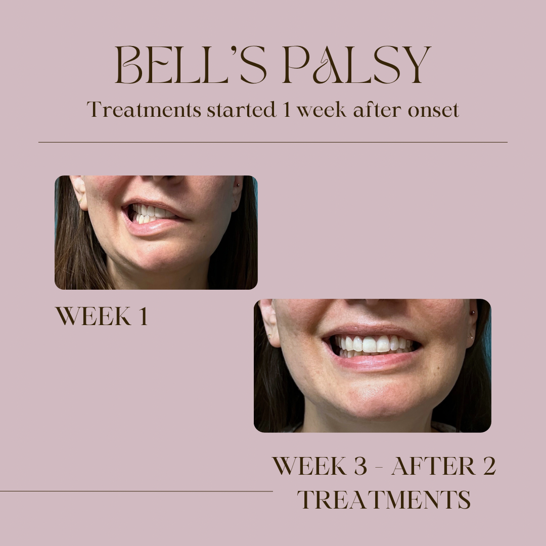 Acupuncture Benefits For Bell's Palsy at Annette Stephens blog