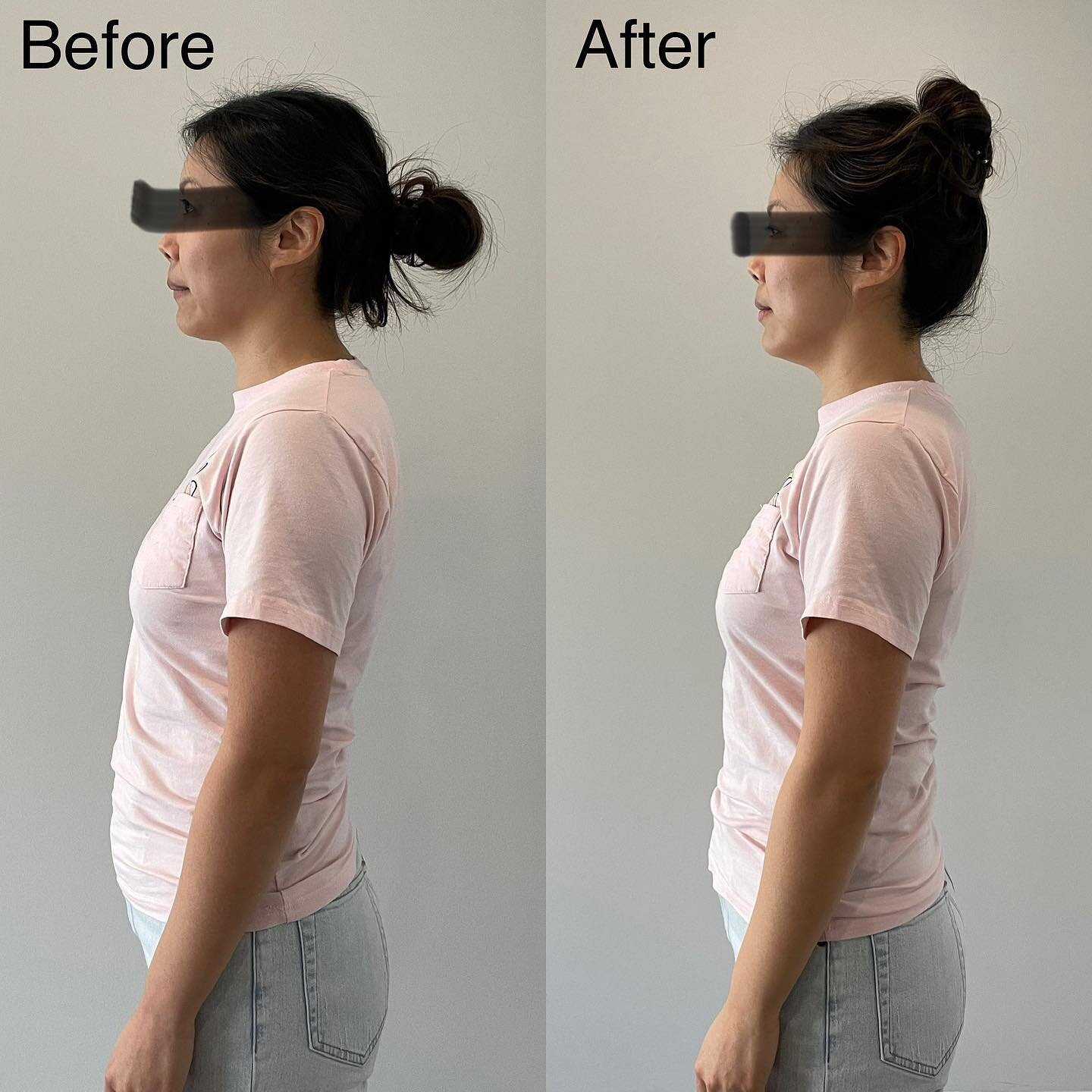 Intramuscular Stimulation (IMS) at PRE Therapy — PRE Therapy