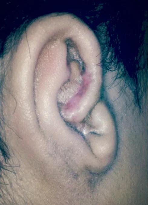 Ear Reconstruction — Dr. Bhumkar Hospital