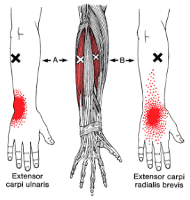 Trigger Points and Elbow Pain — Lanier Therapy in Motion
